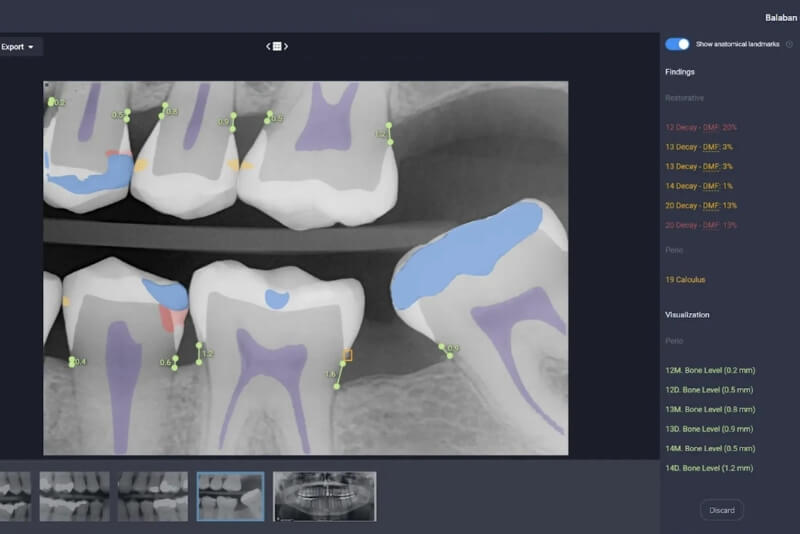 Exam and X-rays - AACD Cosmetic Dentist Newport Beach | Dr. Dimple Desai